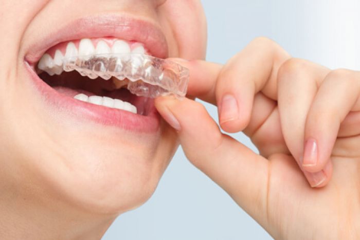 The Science Behind the Success of Teeth Aligners